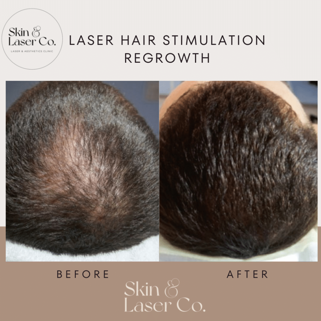 HAIRestart® - Skin Laser Co