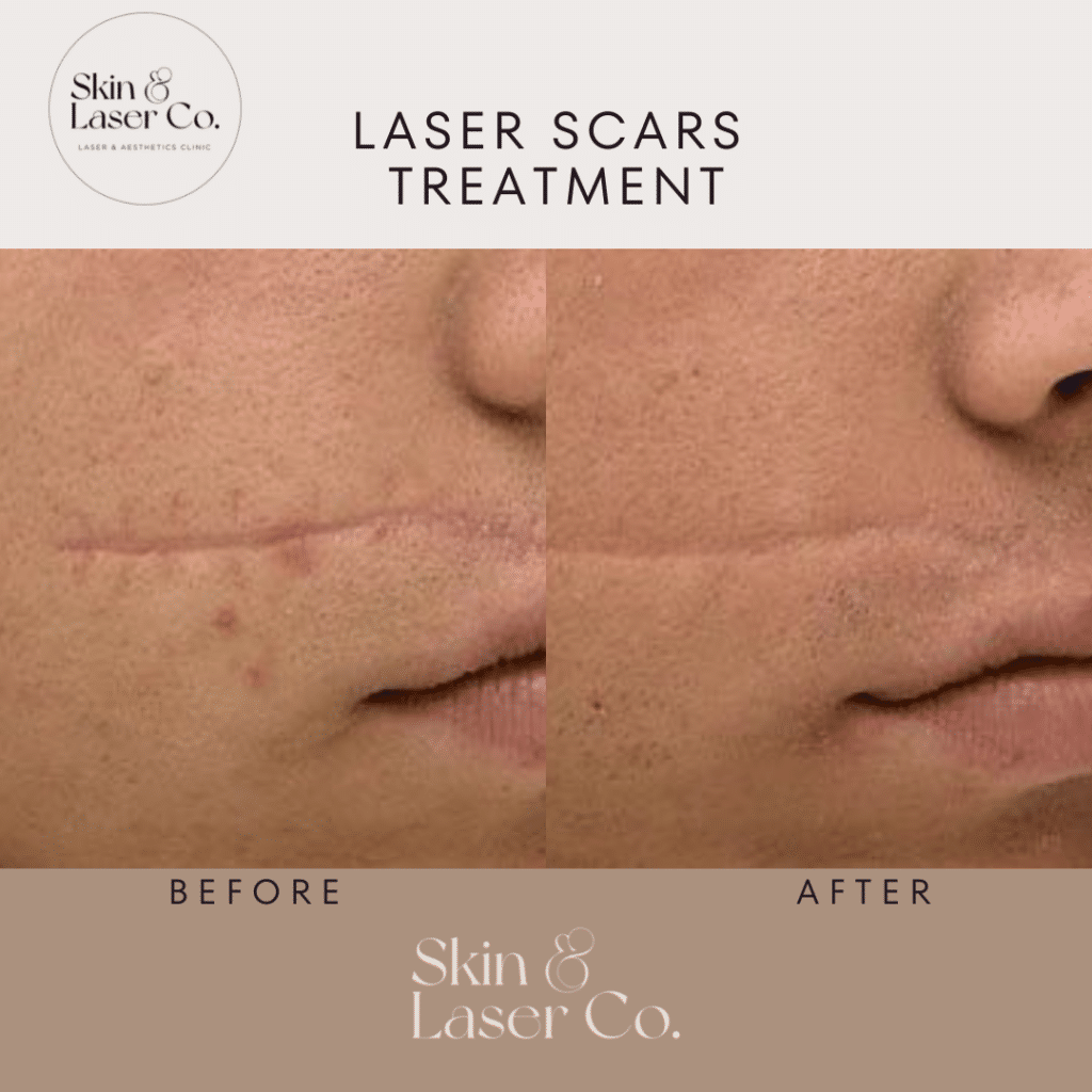 Scarring Treatment Skin Laser Co Scarring Treatment Skin Laser Co