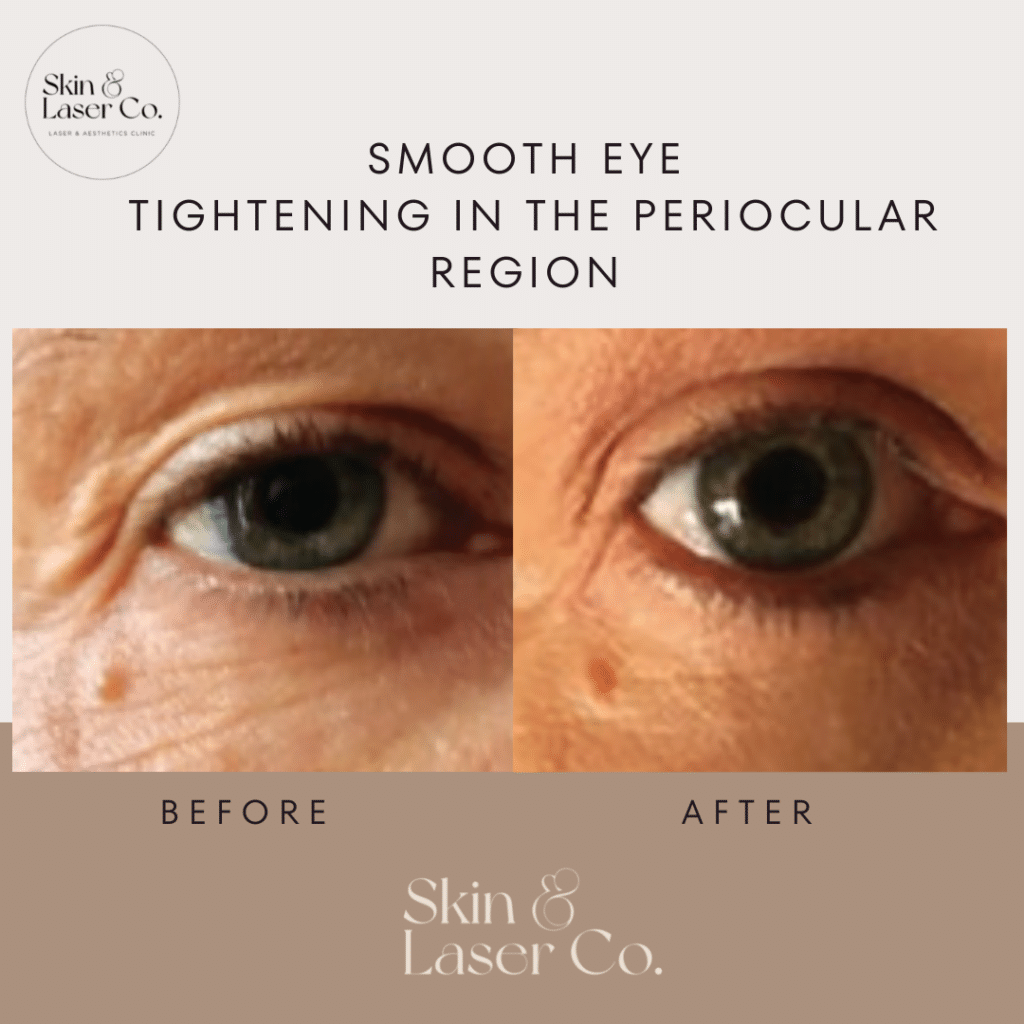 Smooth Eye - Eyelift Treatment - Skin Laser Co
