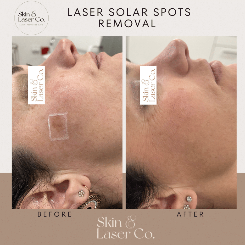 Age/Solar Spot Removal - Skin Laser Co