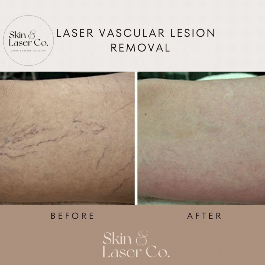 Vein (vascular lesion) Treatment - Skin Laser Co