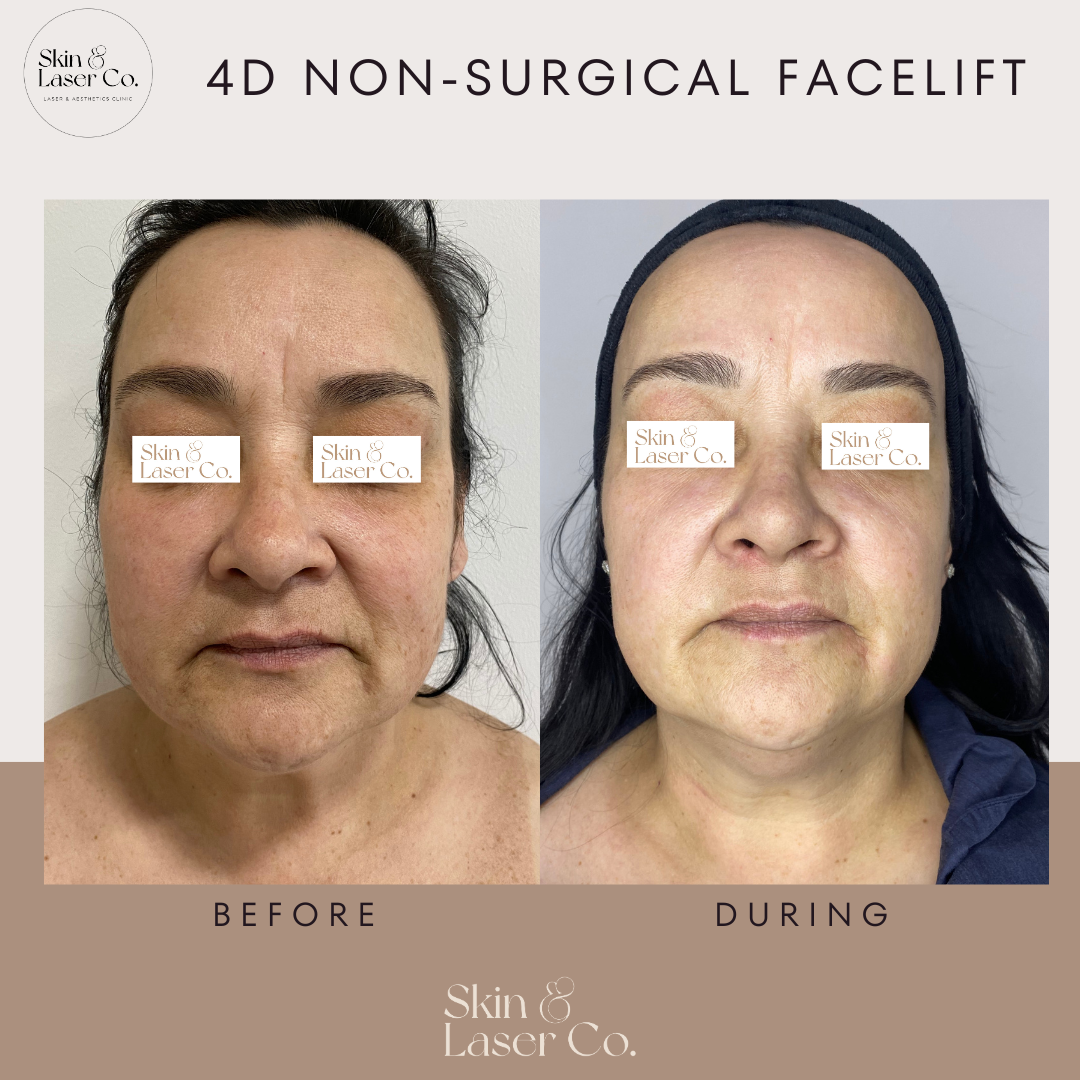 Fotona 4D Non- Surgical Facelift - Skin Laser Co