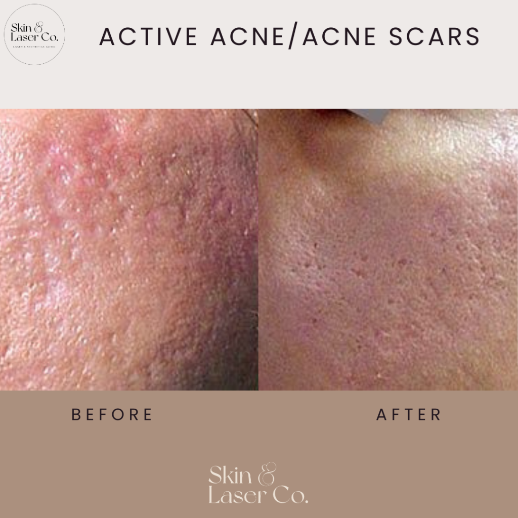 Active Acne/Acne Scar Treatment - Skin Laser Co