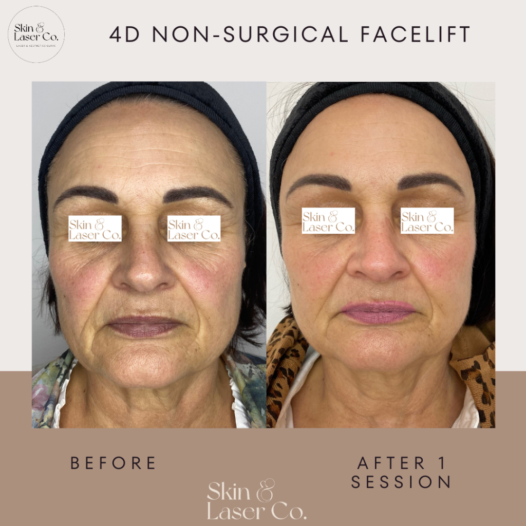 Fotona 4D Non- Surgical Facelift - Skin Laser Co