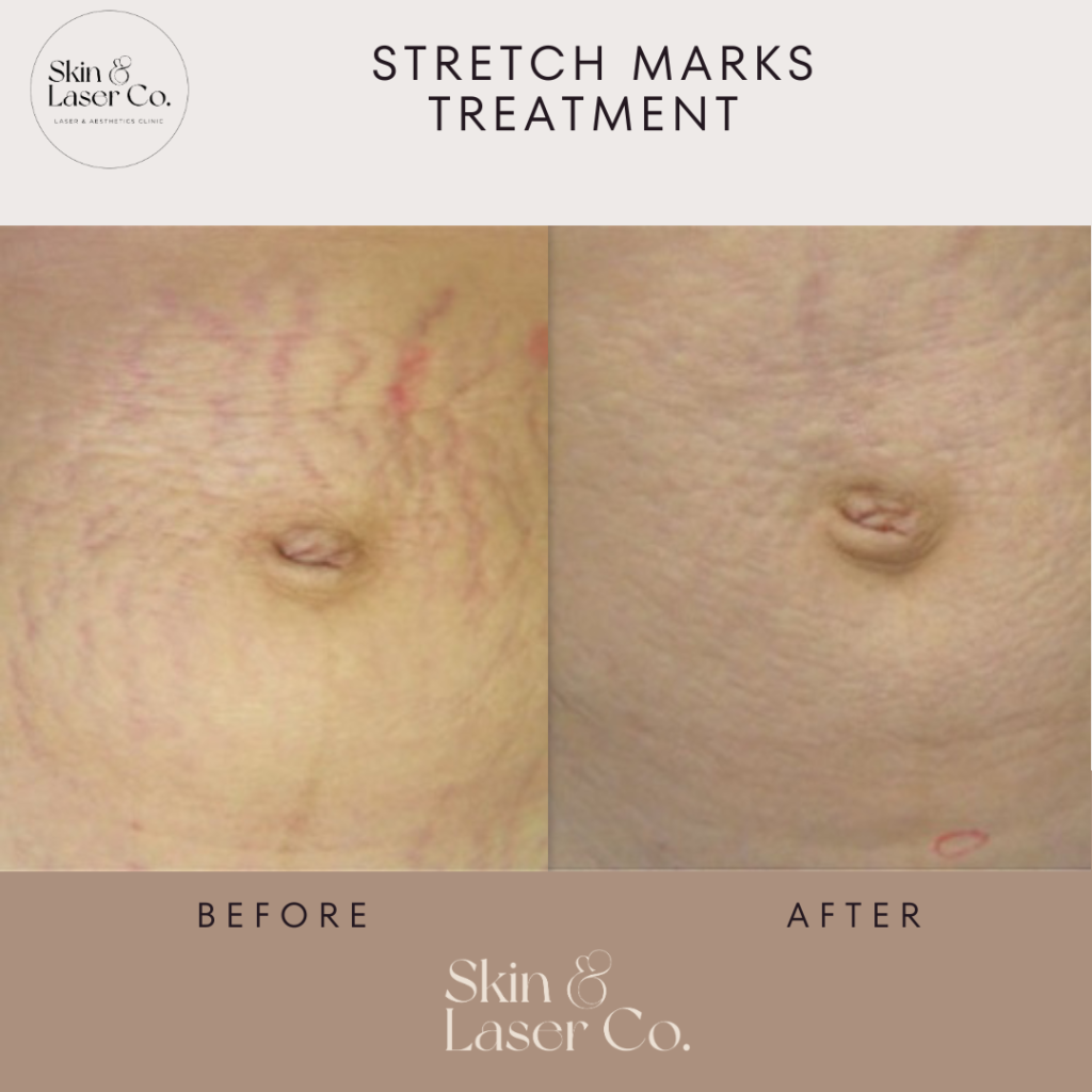 Stretch Mark Treatment - Skin Laser Co